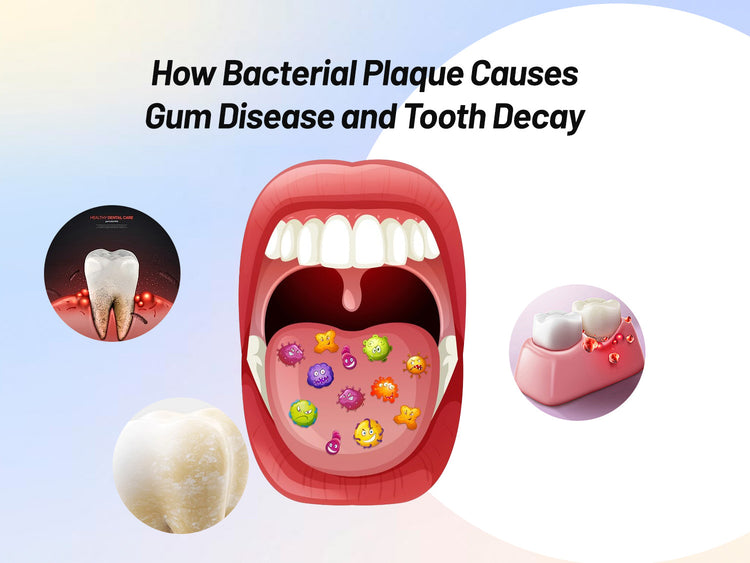 Dental Bacterial Plaque Causes Gum Disease - The Best Way to Prevent ...