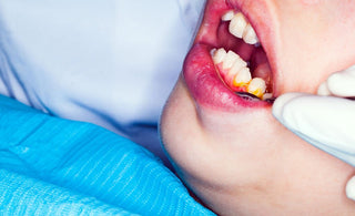 How to Smoke After Tooth Extraction Without Getting Dry Socket – KIWIBIRD