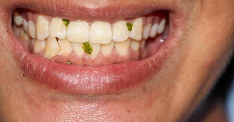 Why Does Food Get Stuck in Your Teeth? | KIWIBIRD